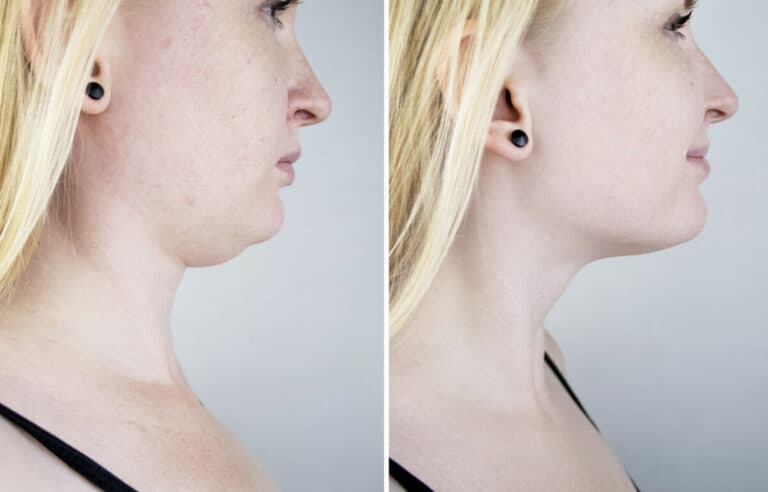 How to Lose Face Fat Quick (Best Exercises to Get a Jawline)
